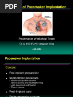 Medtronic Micra Transcatheter Pacing System Patient Brochure | PDF