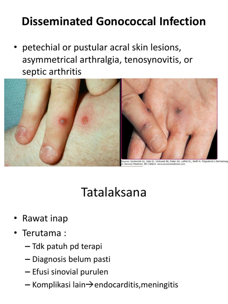 Disseminated Gonococcal Infection