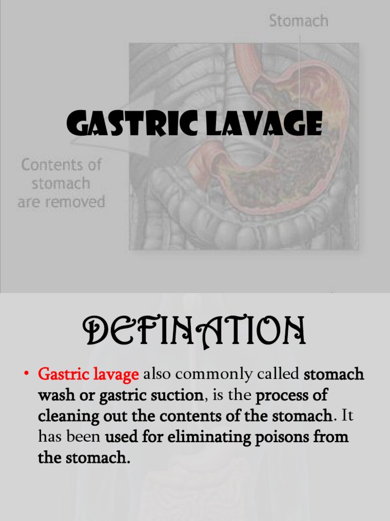 Gastric Lavage: Procedure and Risks | PDF | Medical Specialties ...