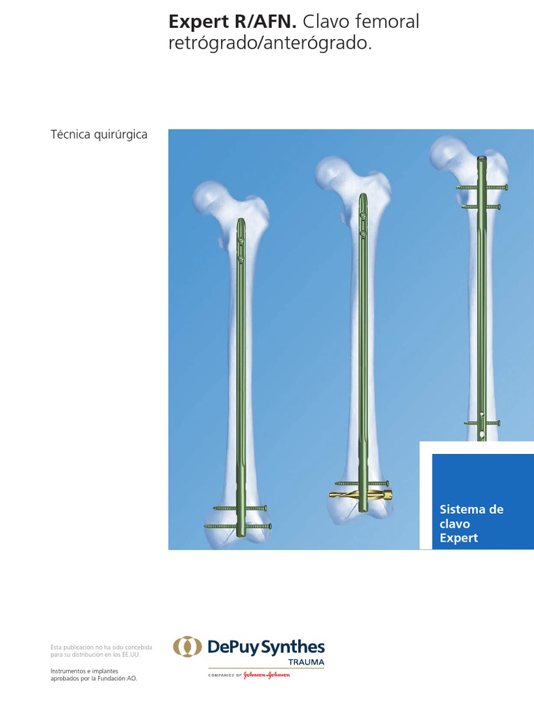 Clavo femur anterogrado-retrogrado Expert.pdf | Tornillo | Sistema ...