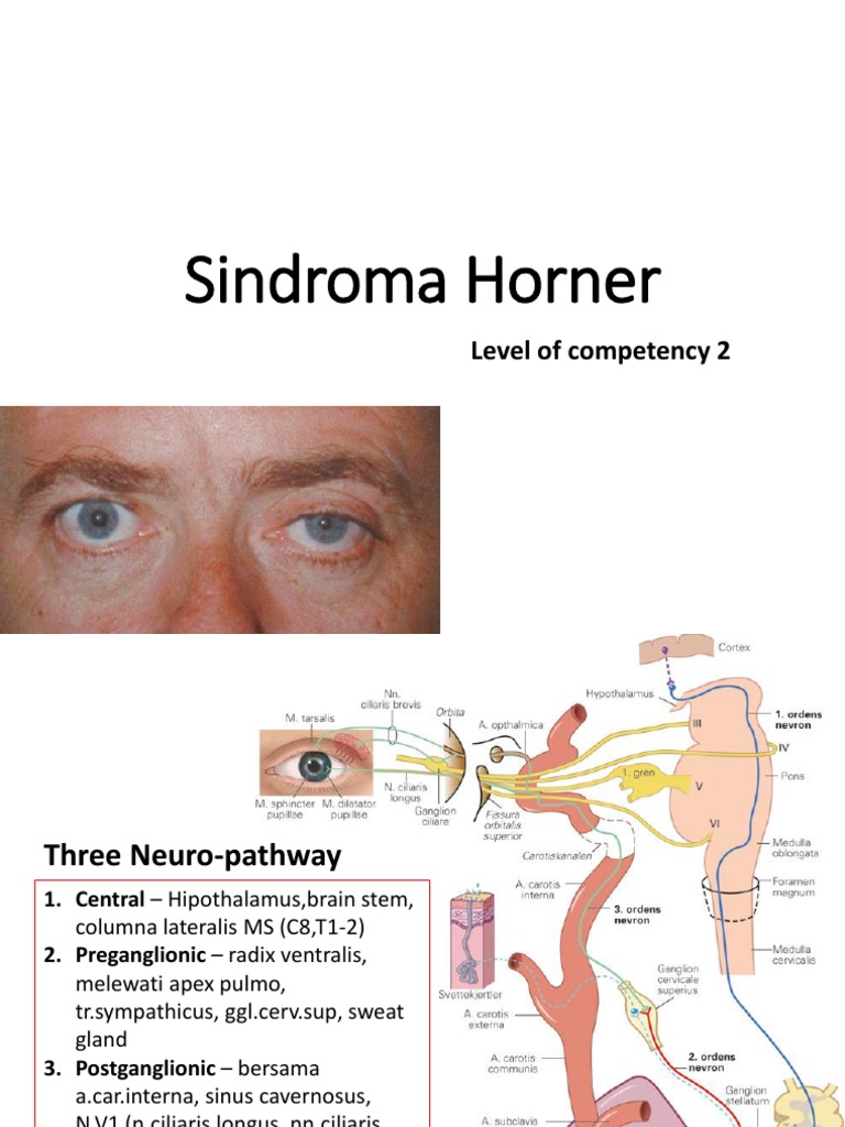 Horner Syndrome