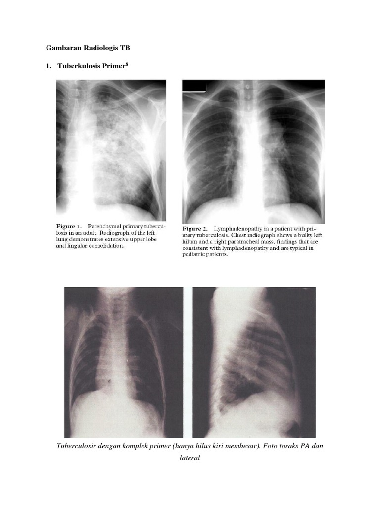 Gambaran Radiologis TB | PDF