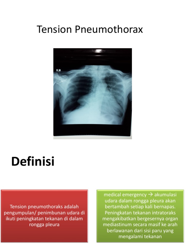 LO Tension Pneumothorax | PDF