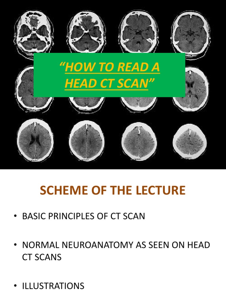 Head CT Scan Basic | PDF