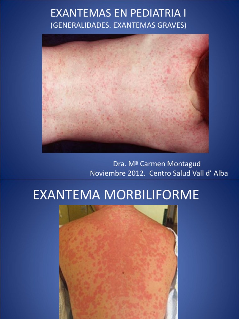 exantemasenpediatriaigeneralidadesyexantemasgraves | Condiciones ...