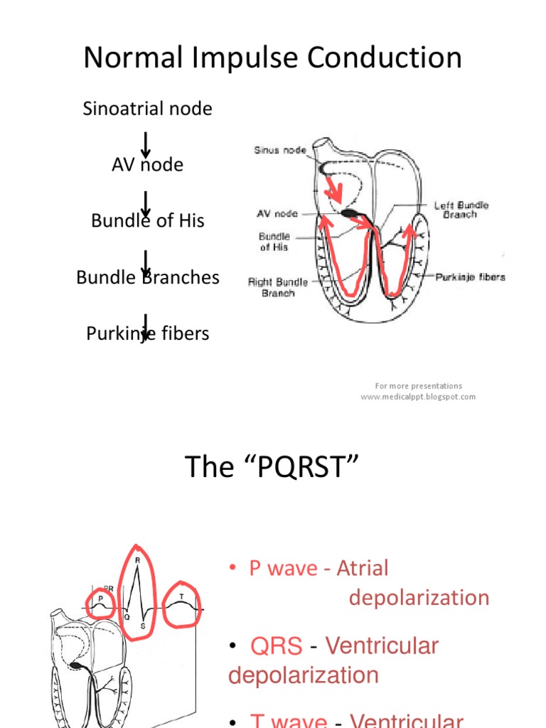 Normal Impulse Conduction: Sinoatrial Node AV Node Bundle of His Bundle ...