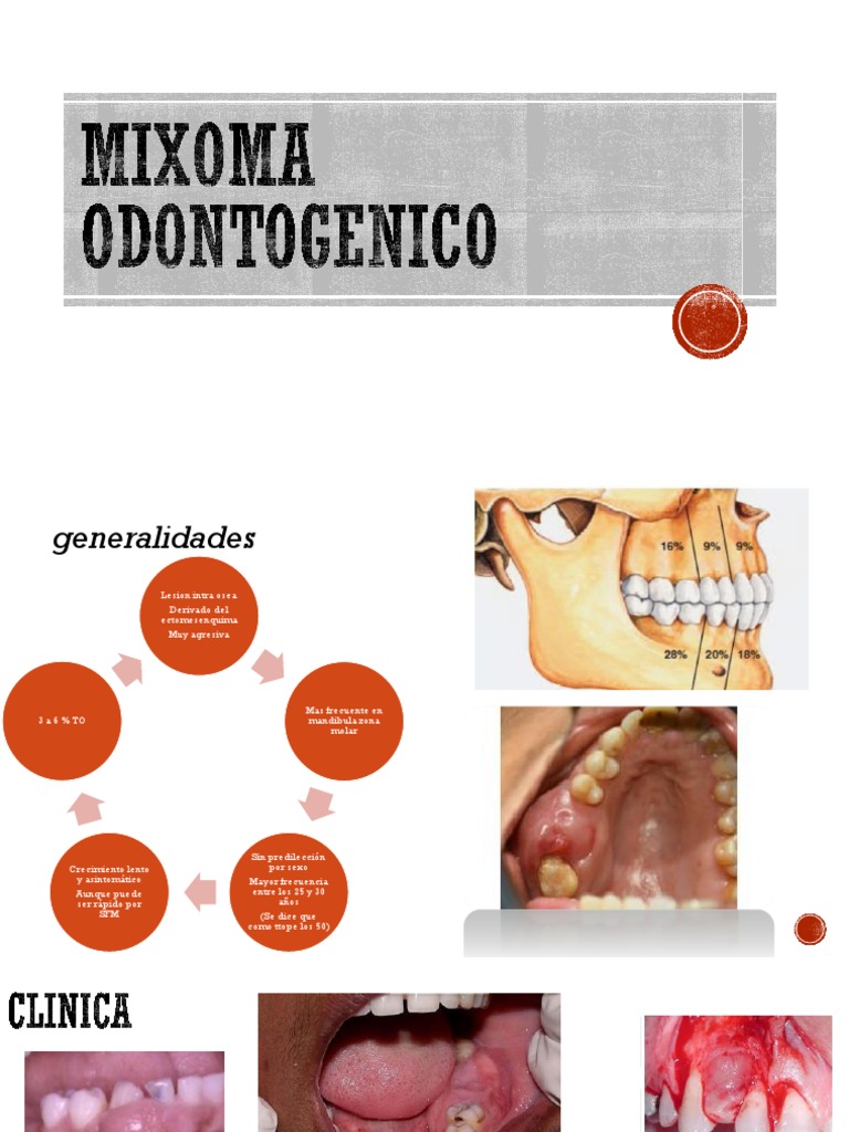 Mixoma Odontogenico | PDF | Hueso | Anatomía