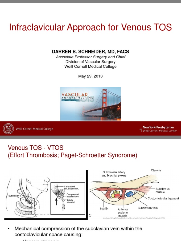 P2-Wed-915 Infraclavicular Approach For VTOS Schneider | Download Free PDF | Vein | Thrombosis