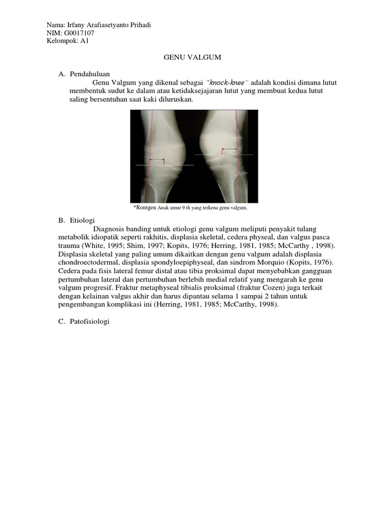 Genu Valgum | PDF