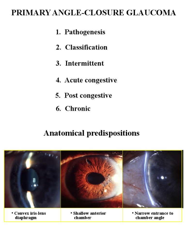 Primary Angle-Closure Glaucoma: 1. Pathogenesis 2. Classification ...