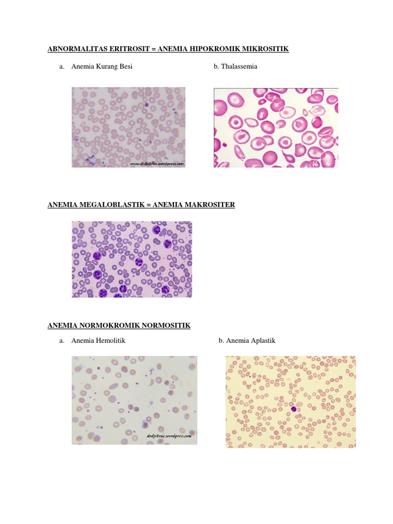 A. Anemia Kurang Besi B. Thalassemia: Abnormalitas Eritrosit Anemia ...