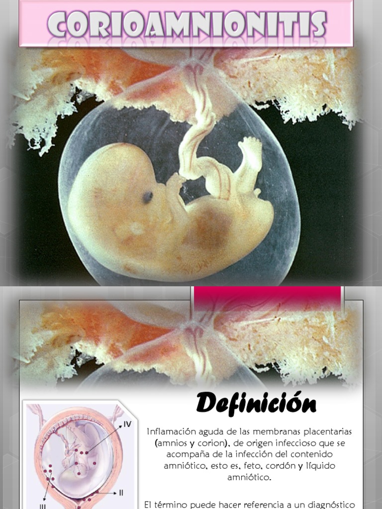 Corioamnionitis - Final | PDF | Leucocito | Salud maternal