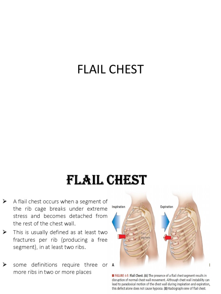 Flail Chest | PDF | Medical Emergencies | Pulmonology
