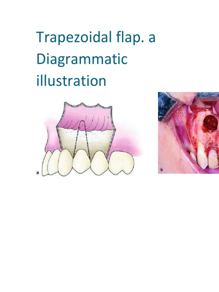 Trapezoidal Flap. A Diagrammatic Illustration | PDF | Teaching Methods ...