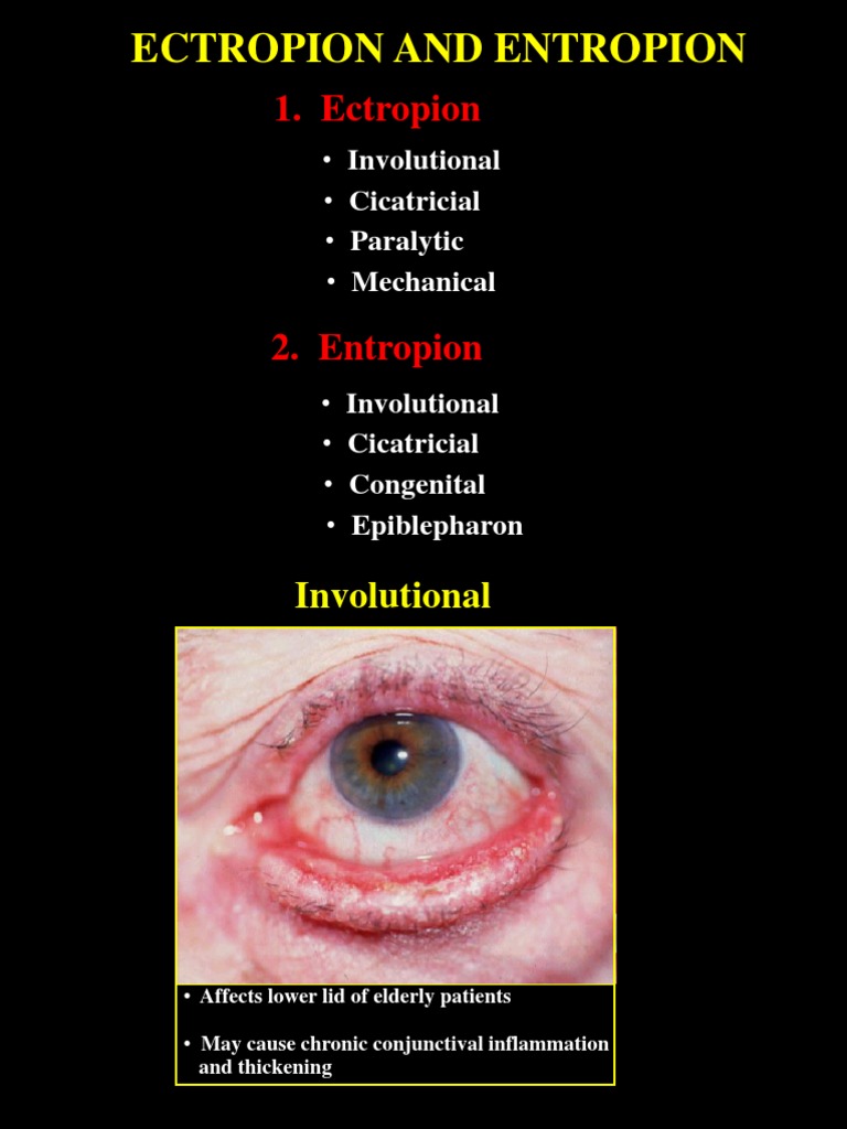 06Ectropion & Entropion | Scar | Ophthalmology