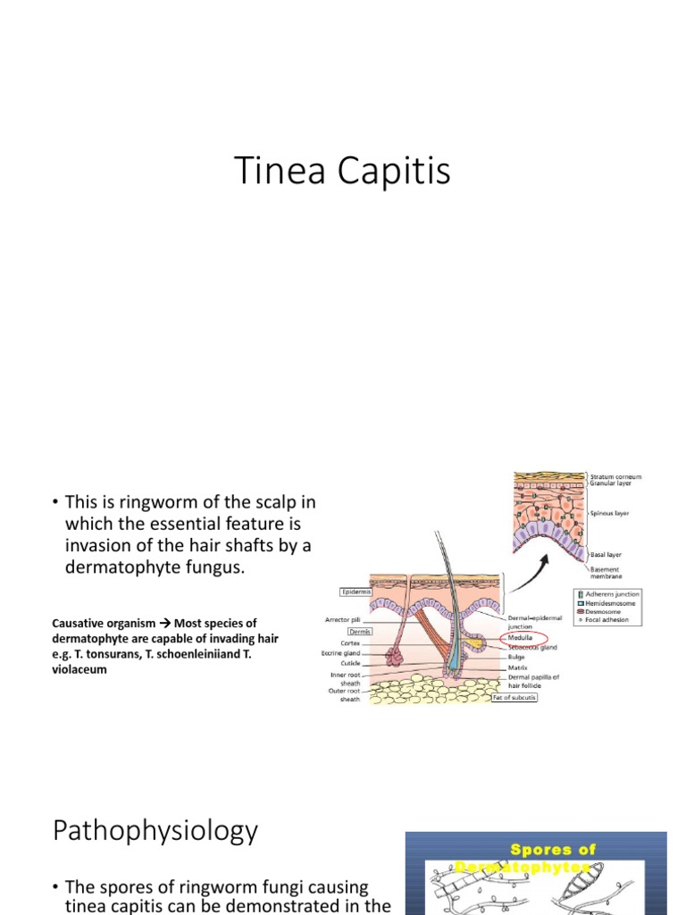 Tinea Capitis | PDF | Medicine | Clinical Medicine