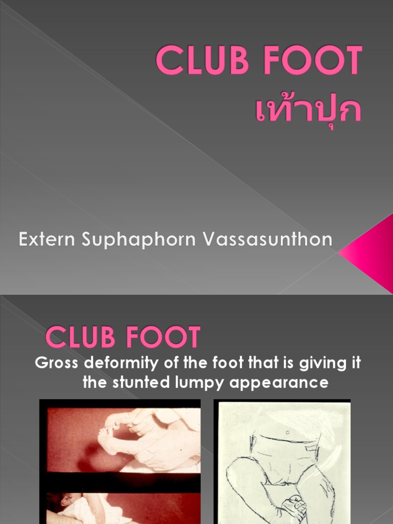 Club Foot | PDF | Foot | Ankle