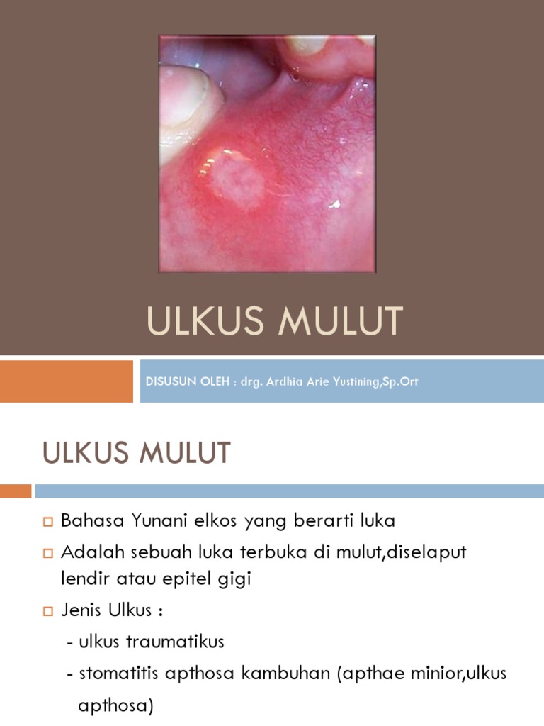 Jenis dan Pengobatan Ulkus Mulut | PDF
