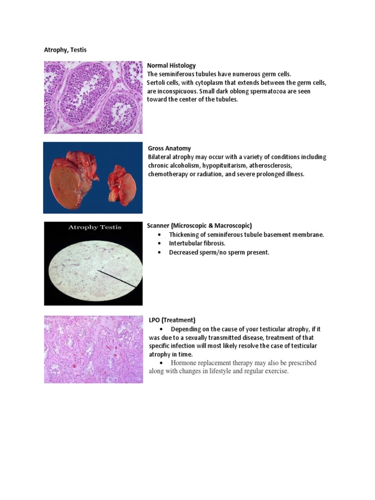 Atrophy | Cardiac Muscle | Atrophy