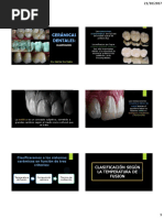 Porcelana Feldespática en Odontología | PDF