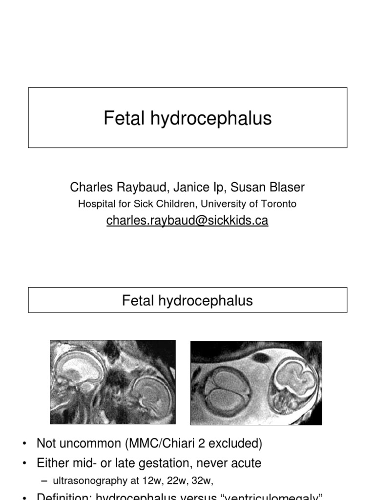 Fetal Hydrocephalus: Charles Raybaud, Janice Ip, Susan Blaser Charles ...
