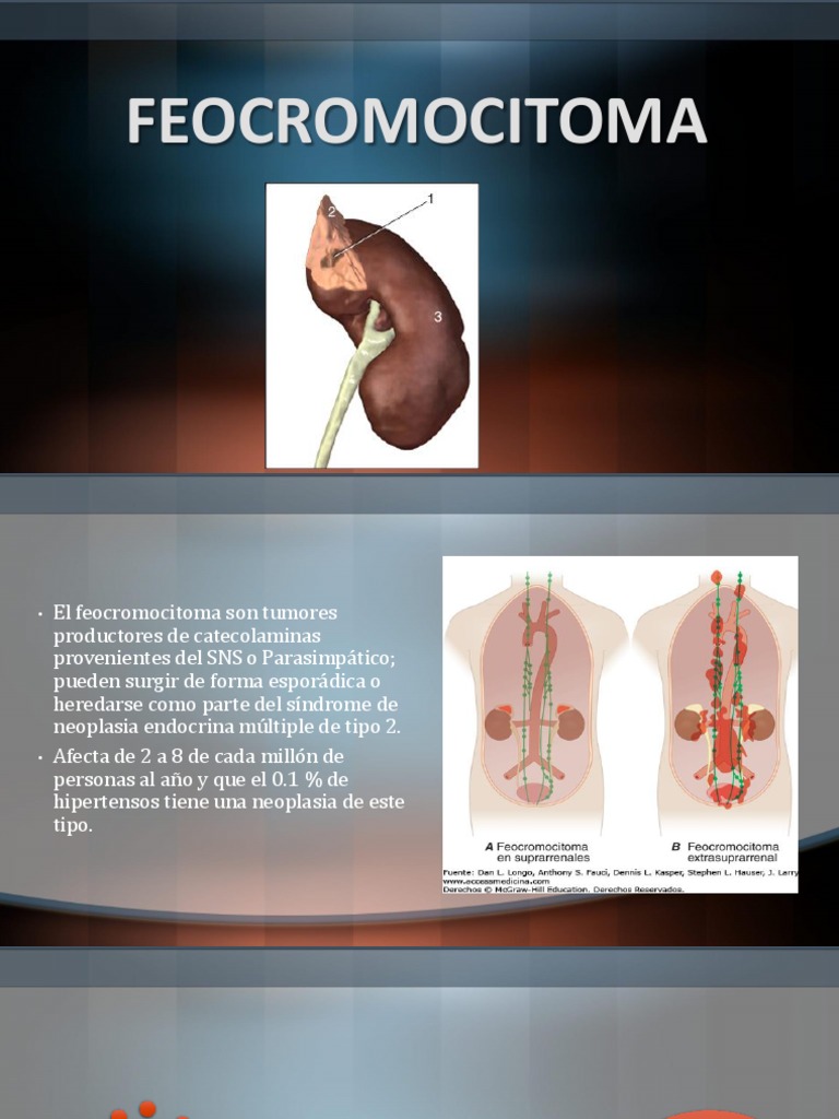 FEOCROMOCITOMA | PDF | Epinefrina | Enfermedades y trastornos