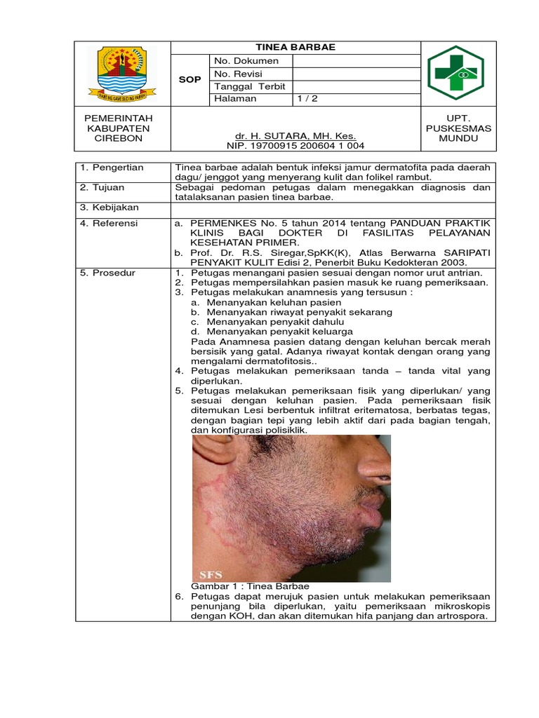 Sop Tinea Barbae | PDF