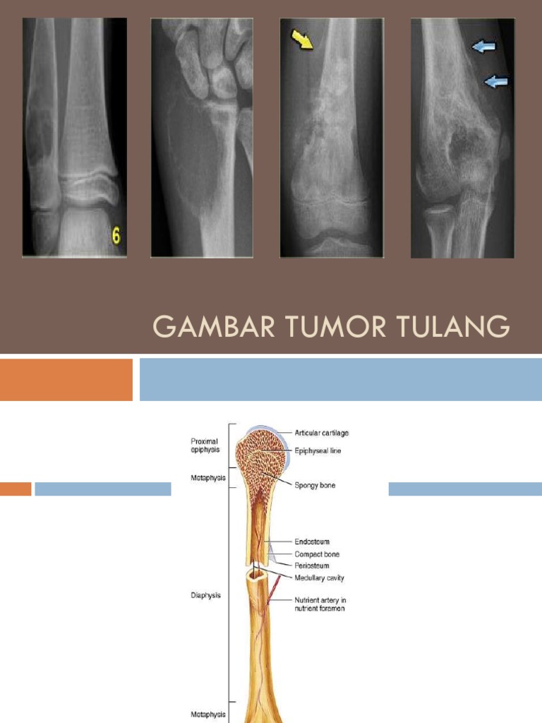 Radiologi Tumor Tulang | PDF