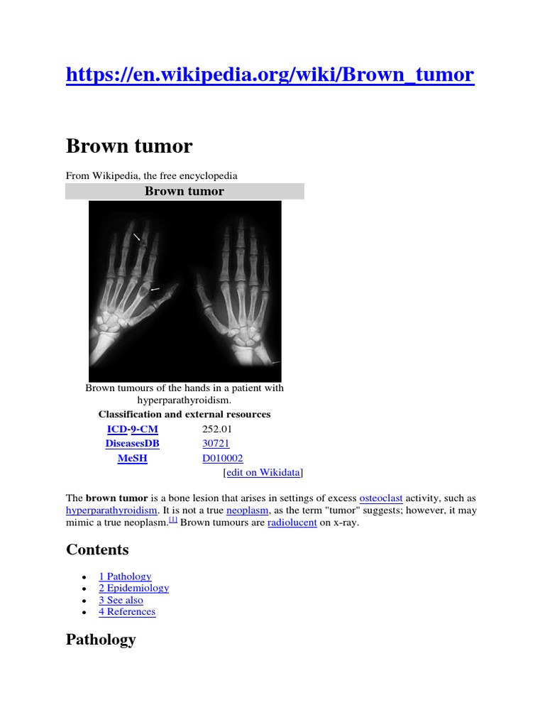 Brown Tumor - Wikipedia | Musculoskeletal System | Diseases And Disorders