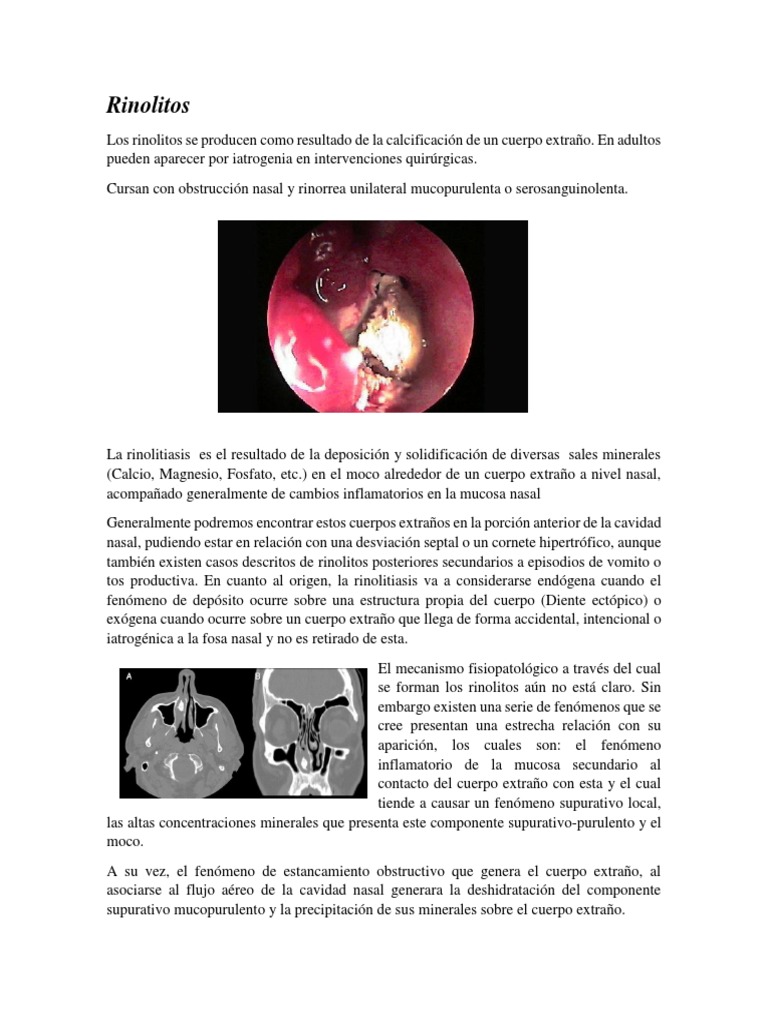 Rinolitos y Trastornos Nasales | PDF | Pecho | Especialidades Medicas