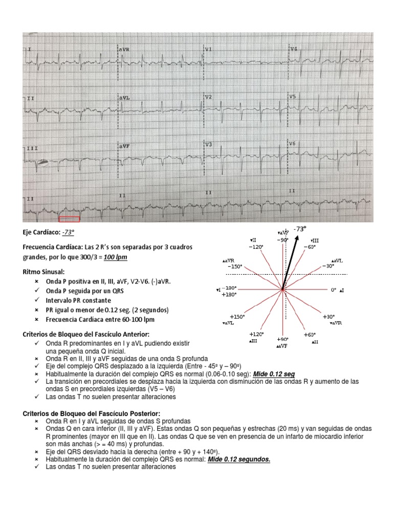 Criterios Ritmo sinusal, bloqueo de fasiculo anterior y posterior