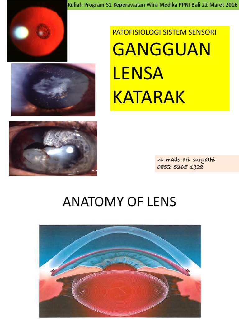 Gangguan Lensa Katarak | PDF | Cataract | Ophthalmology