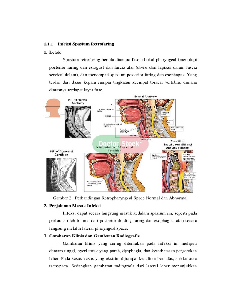 Infeksi Spasium Retrofaring | PDF