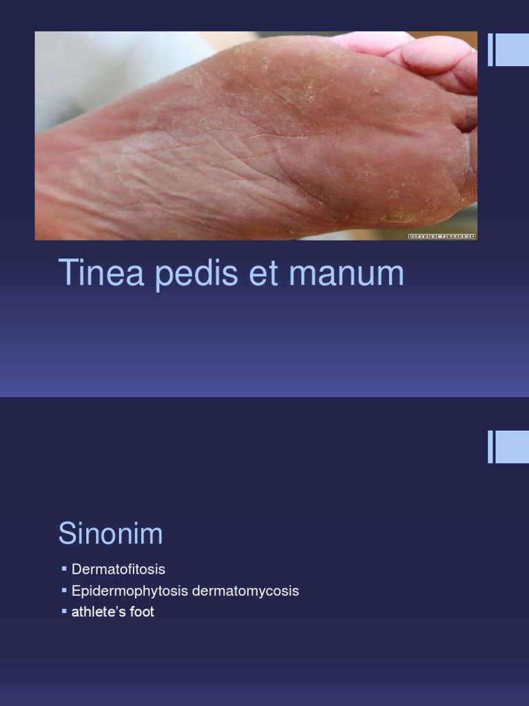 Tinea Pedis | PDF
