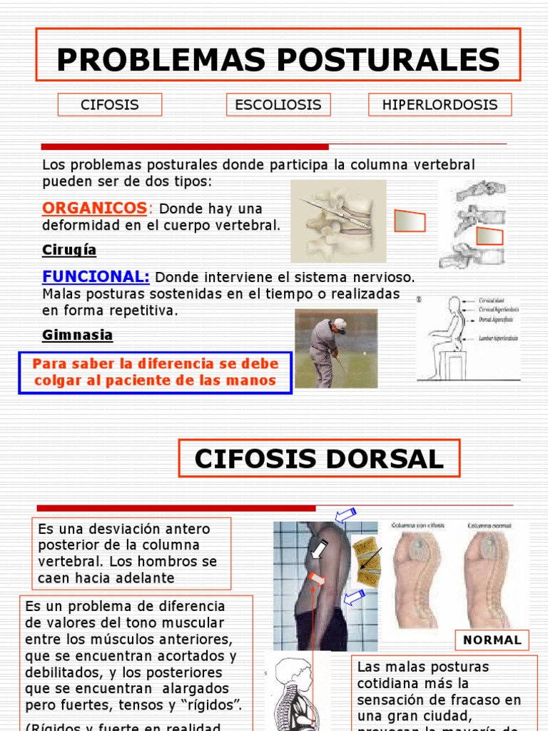 Problemas Posturales Varios | PDF | Escoliosis | La columna vertebral