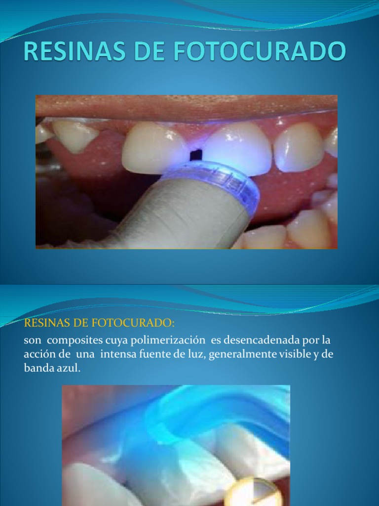 9resinas de Fotocurado | Esmalte dental | Grabado