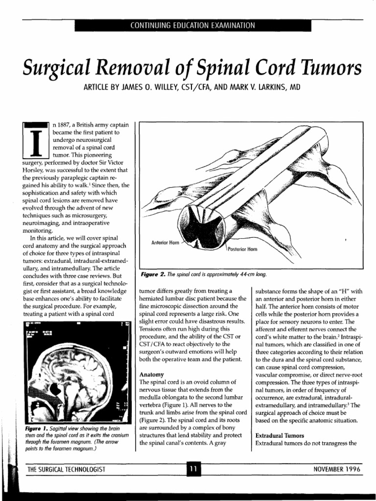 Surgical Removal of Spinal Cord Tumors: An Overview of Anatomy ...