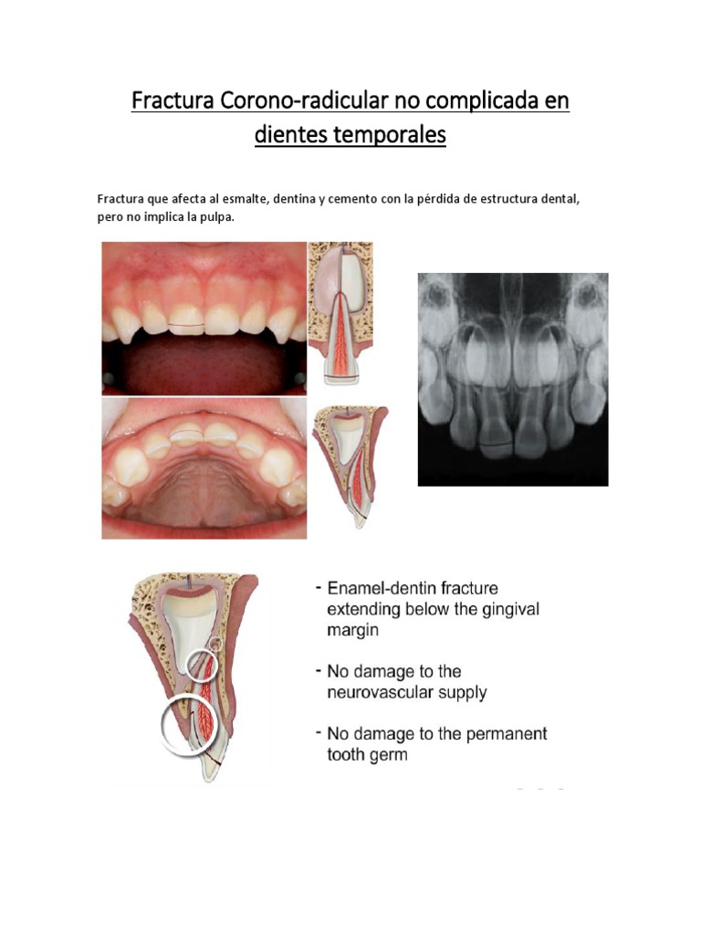 Fractura Coronoradicular No Complicada Dientes Temporales | PDF ...