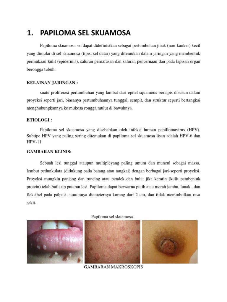 Papiloma Sel Skuamosa, Karsinoma Sel Skuamosa, Adenoma Thyroid ...