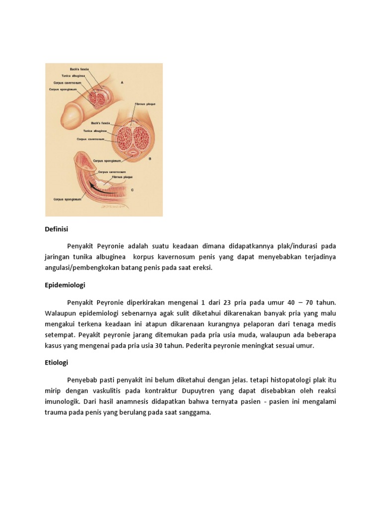 Penyakit Peyronie: Gejala, Penyebab, dan Terapi | PDF