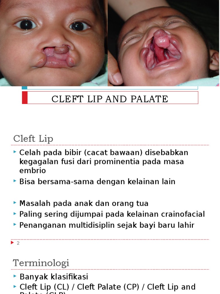 A Comprehensive Overview of Cleft Lip and Palate | PDF