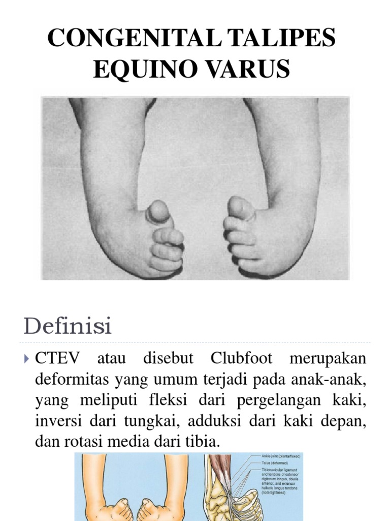 Congenital Talipes Equino Varus | PDF