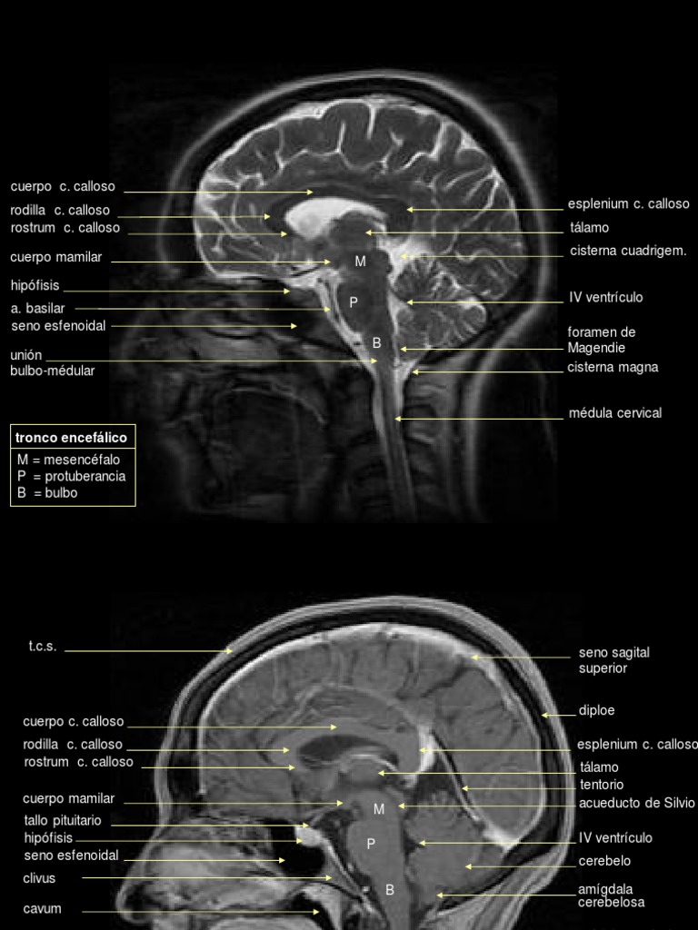 Cerebro Normal | Cerebelo | Tálamo