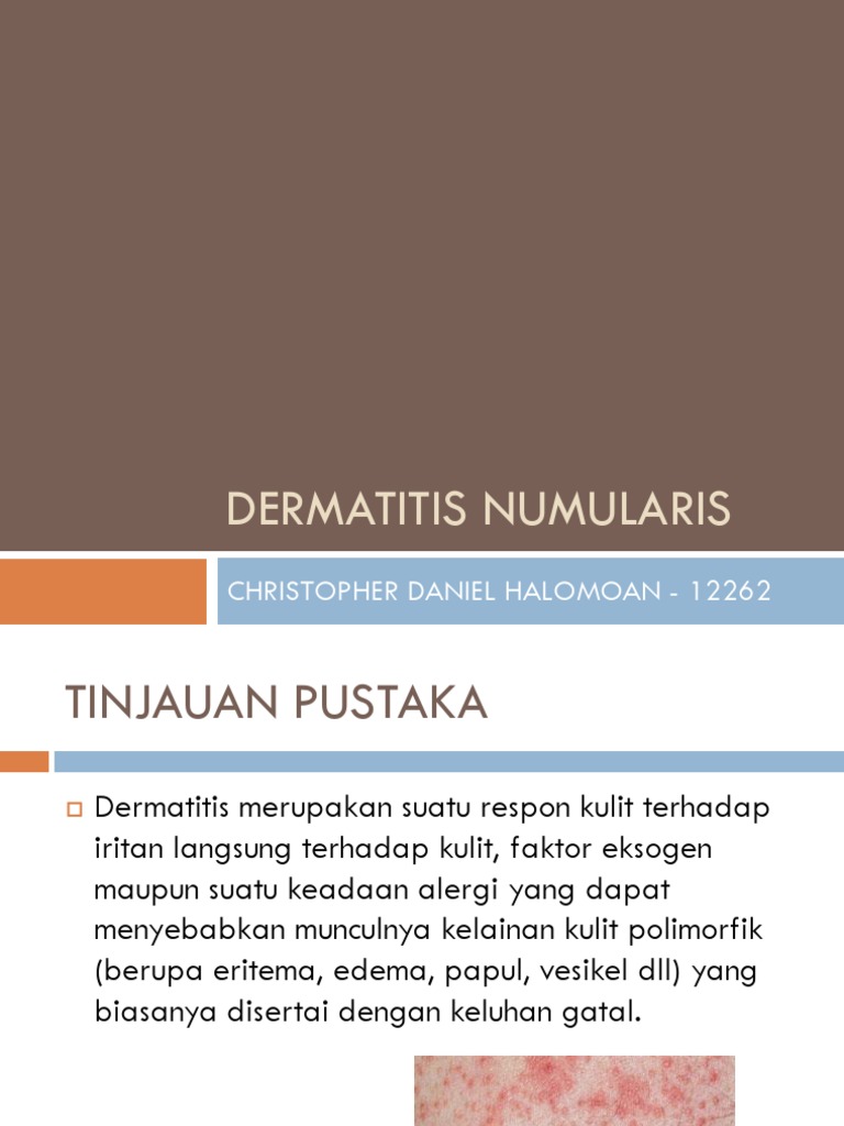 Dermatitis Numularis | PDF