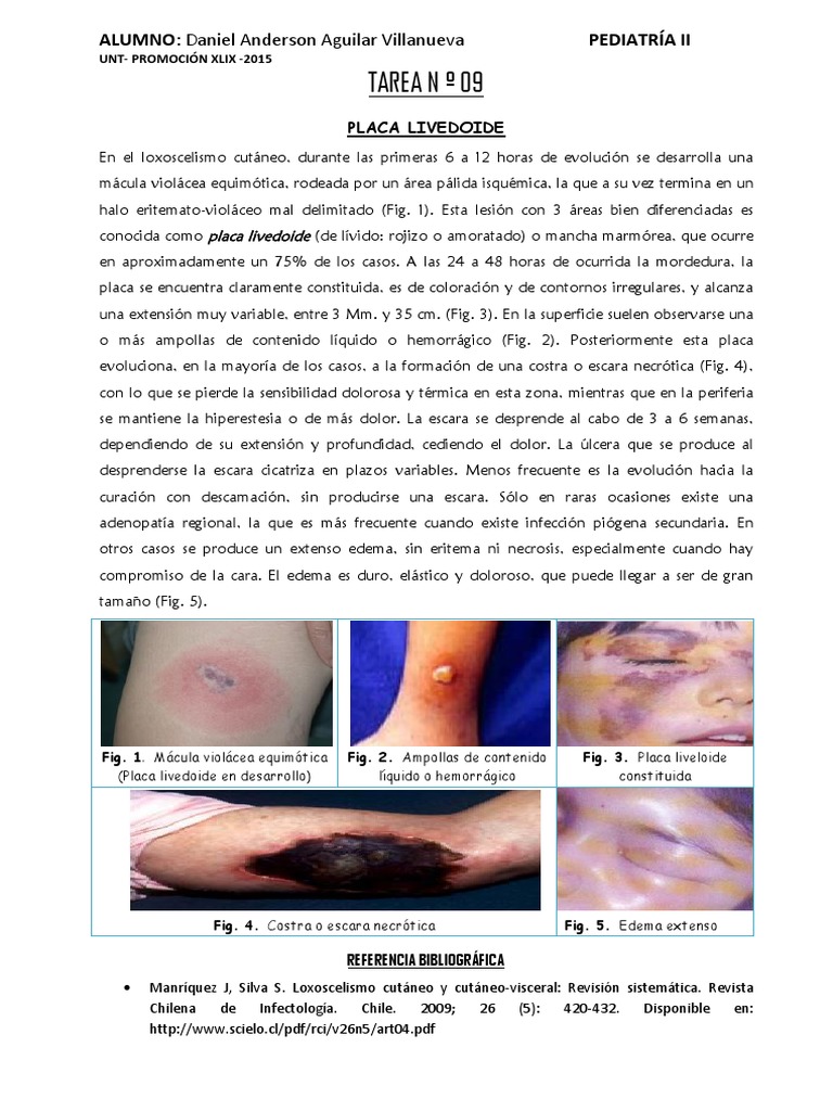 Placa Livedoide | PDF