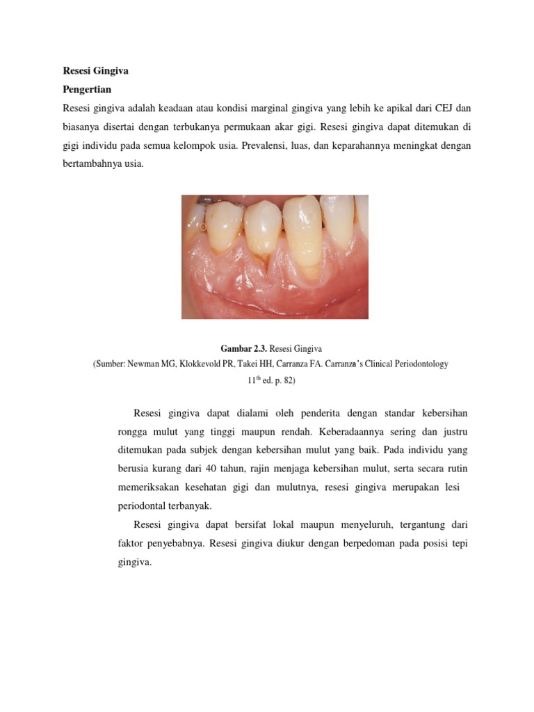 Klasifikasi Resesi Gingiva Menurut Miller | PDF | Sains & Matematika