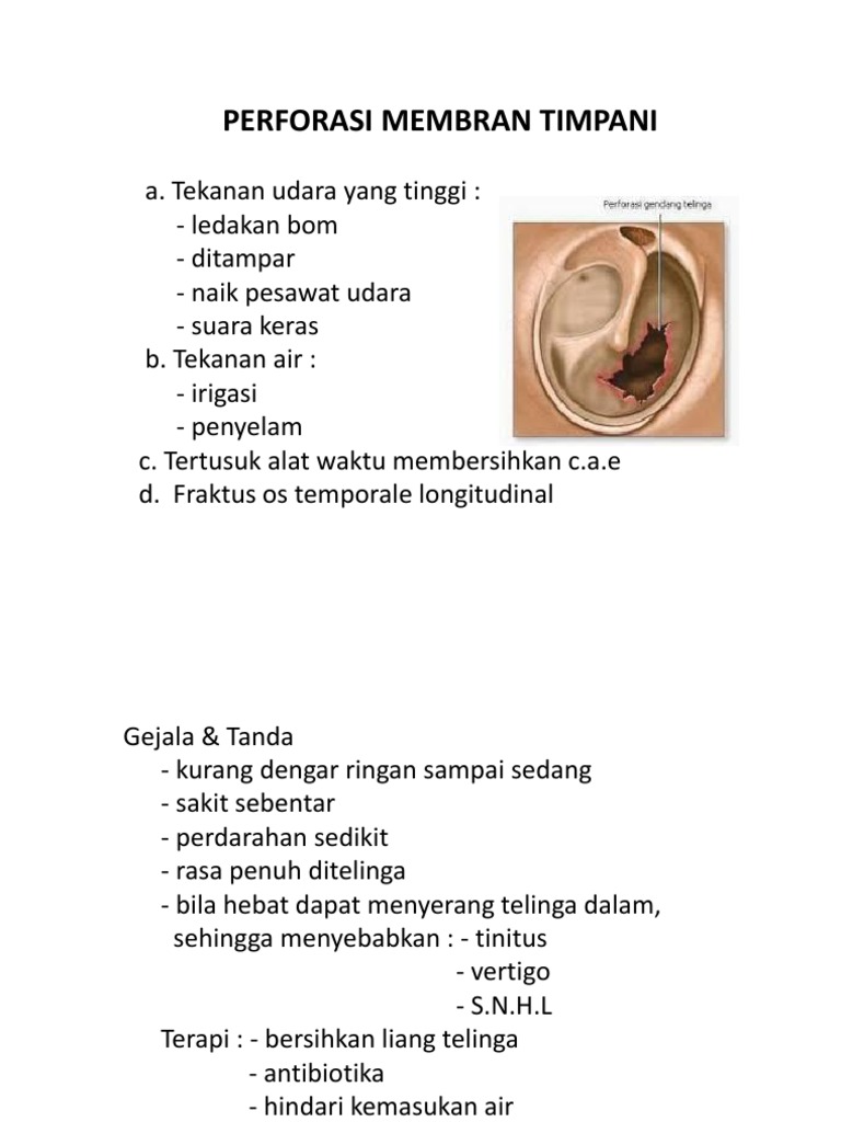 Perforasi Membran Timpani | PDF