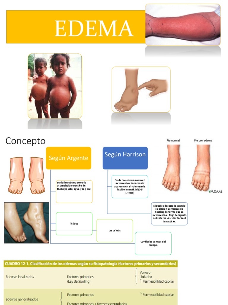 Seminario de Edema | PDF | Edema | Especialidades Medicas