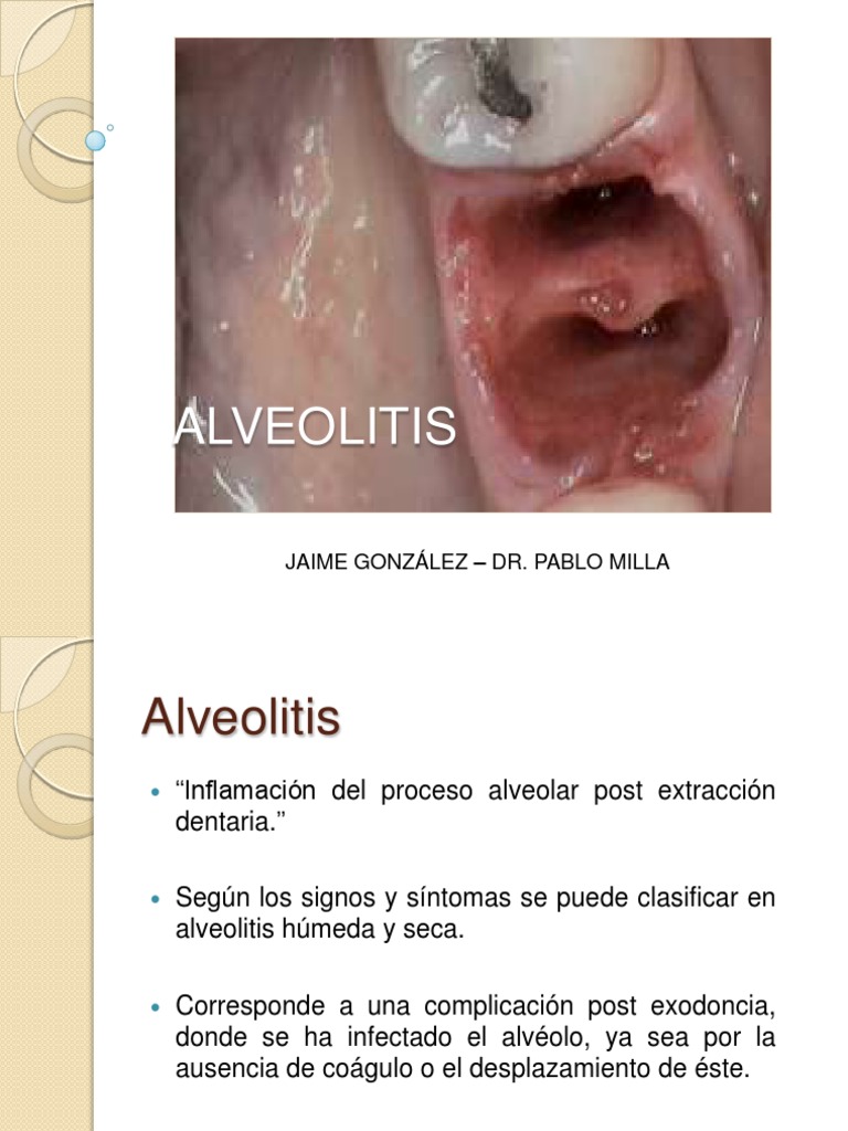 alveolitis-130527180045-phpapp02 | Cuidado de la salud | Salud pública