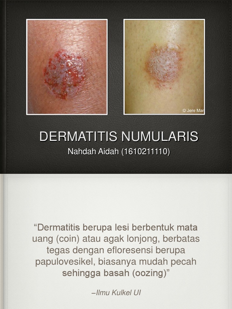Dermatitis Numularis11 | PDF